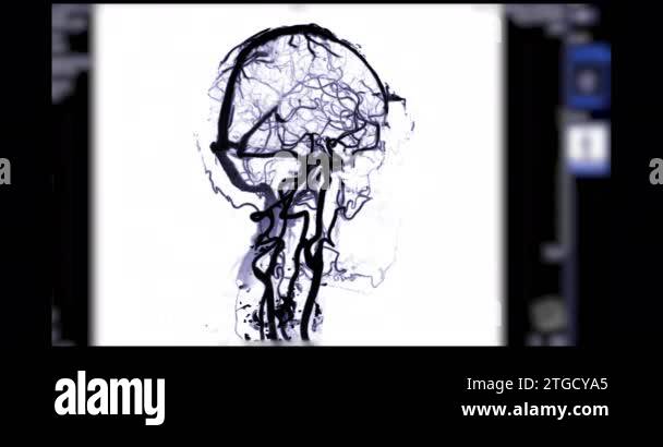 Venous thrombosis Stock Videos & Footage - HD and 4K Video Clips - Alamy