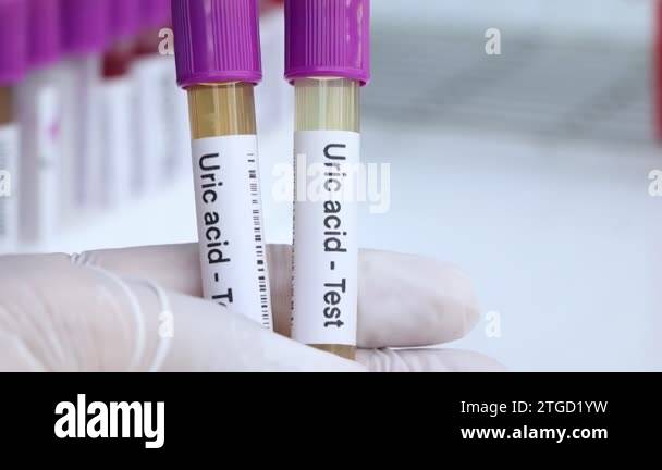 Uric acid test to look for abnormalities from Urine, Urine sample to ...