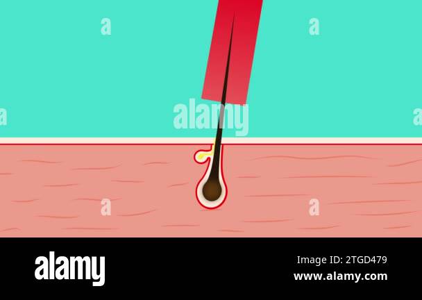 Body hair removal from the root using laser 4K animation. Removing hair ...