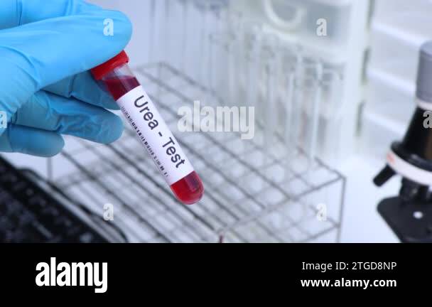 Urea test to look for abnormalities from blood, blood sample to analyze ...