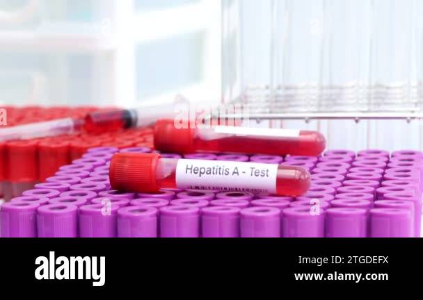 Hepatitis A test to look for abnormalities from blood, blood sample to ...