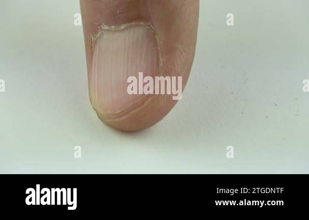 Vertical ridges on the fingernails symptoms deficiency vitamins and ...