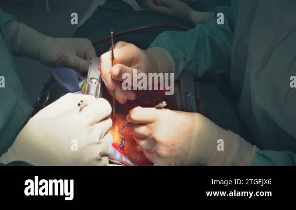 Procedure coronary artery bypass Stock Videos & Footage - HD and 4K ...