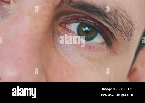 Bruise over the eye of a man, close-up. Young male face with a black ...
