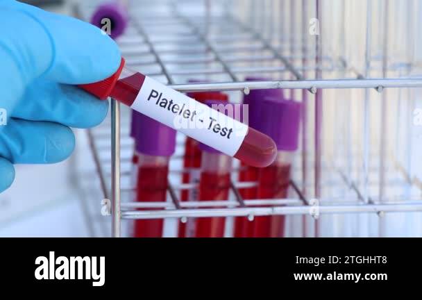 platelet test to look for abnormalities from blood, blood sample to ...