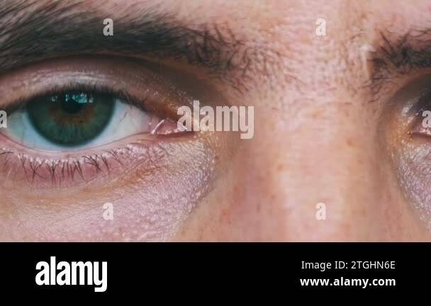 A real black eye on the young male face. A bruise on a mans eyelid ...