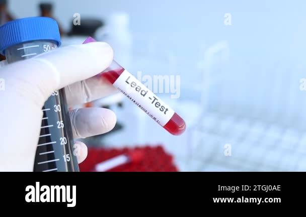 Lead test to look for abnormalities from blood, blood sample to analyze ...