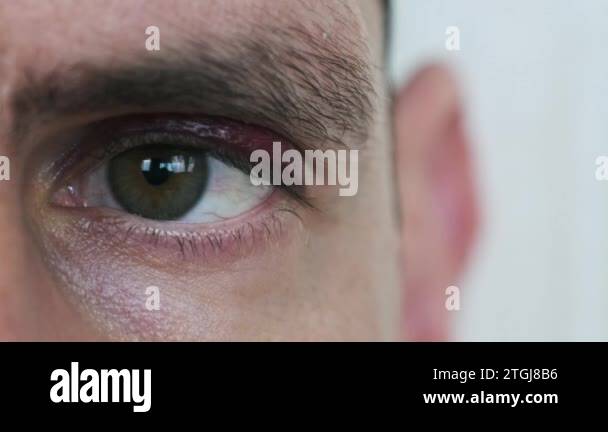 Bruise over the eye of a man, close-up. Young male face with a black ...