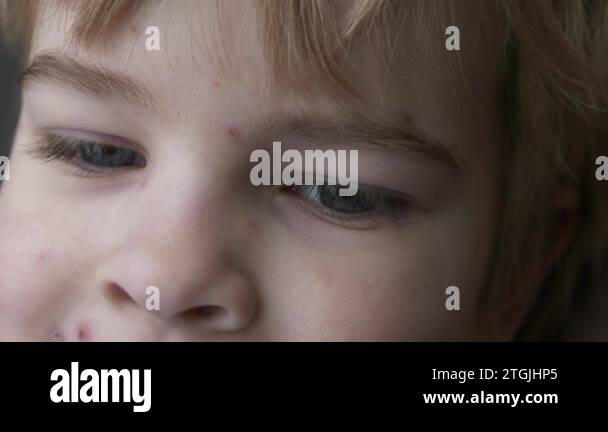 Close-up Kid Face Covered with Rash of Itchy Inflamed Blisters ...