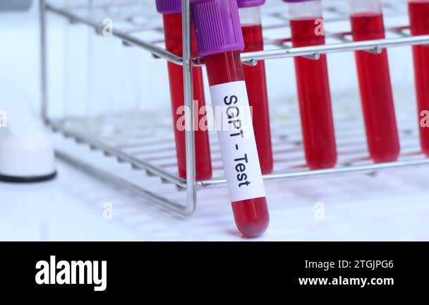 SGPT test to look for abnormalities from blood, blood sample to analyze ...