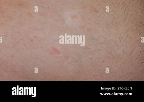A person applies a gel to an allergic area of the skin. Allergic rash ...