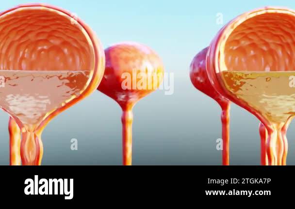 urine color, Light yellow to red urine color, detailed urinary bladder ...