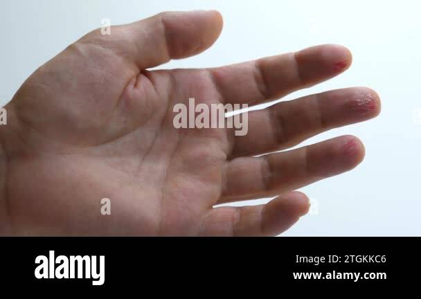 Mens palm hand with injured fingers. Scratched skin bloody wound on ...
