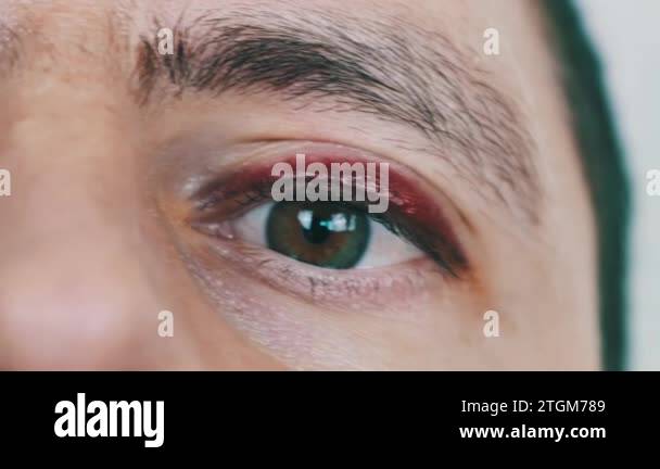 A real black eye on the young male face. A bruise on a mans eyelid ...