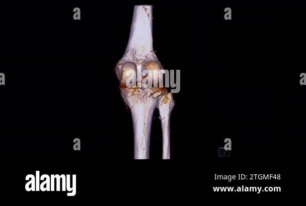 Knee 3D from CT Scan of knee joint 3d rendering image turn around on ...
