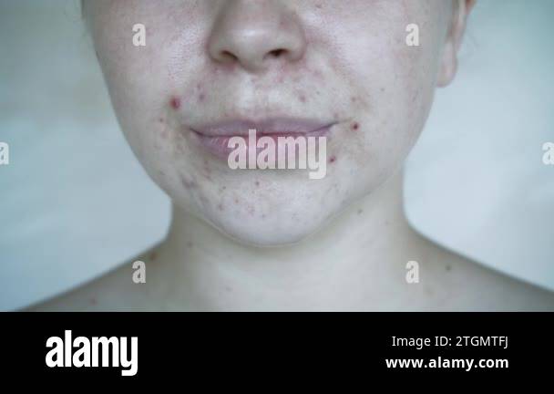 Close up of skin problems, unhealthy skin with acne and pimples. Porous ...