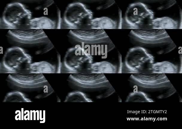 Multi-screen ultrasound of a small baby at 12 weeks. 12 weeks pregnant ...