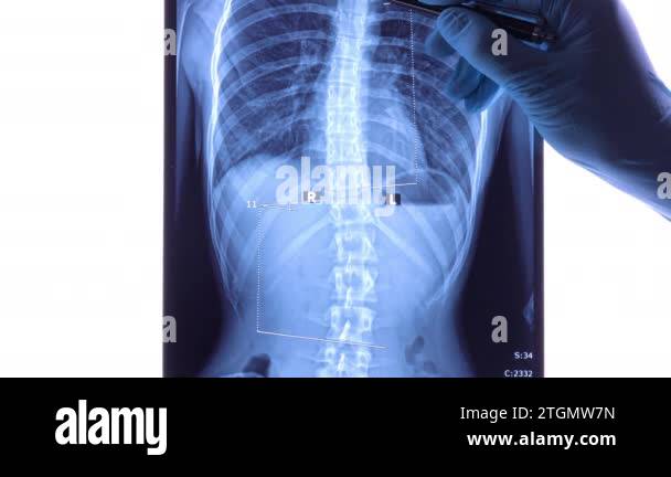 X ray of the spine showing scoliosis in the lumbar area. Scoliosis is ...
