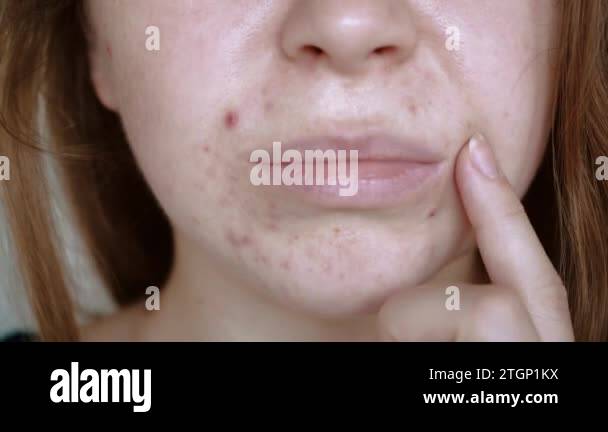 Close up of skin problems, unhealthy skin with acne and pimples. Porous ...