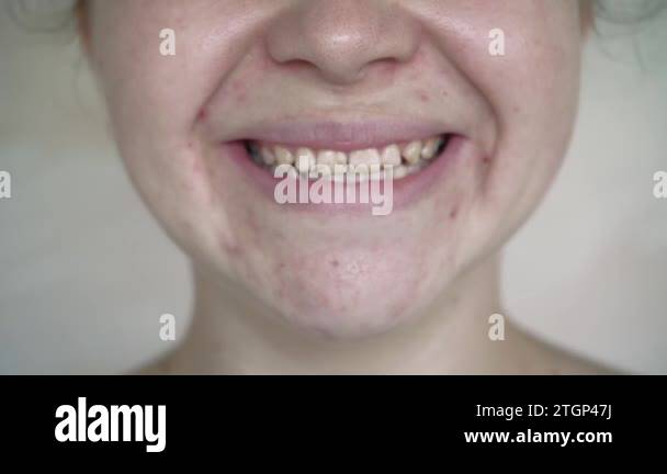 The Girl Smiles Showing A White Spot On The Tooth Fluorosis In The 0111