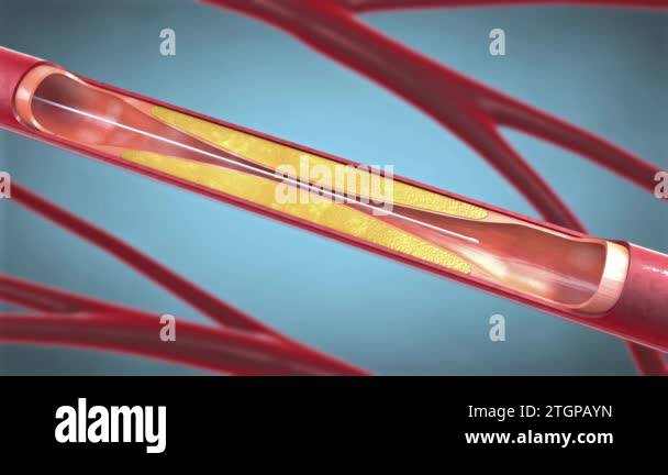 Stent implantation for supporting blood circulation into blood vessels ...