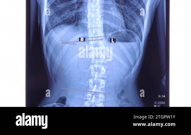 X ray showing scoliosis of the lumbar spine. Scoliosis is an abnormal ...