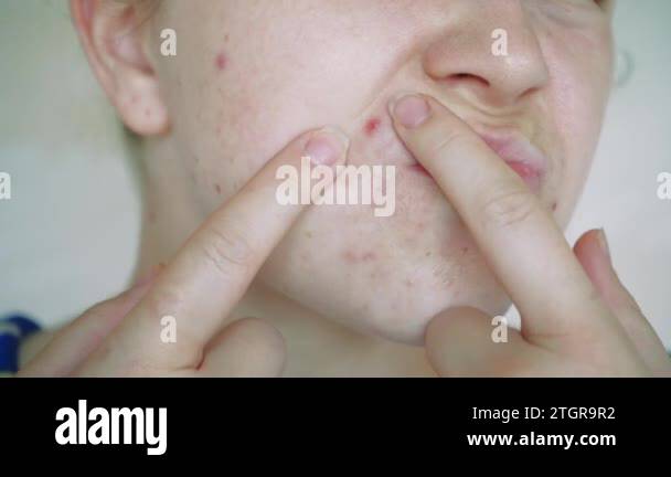 Close up of skin problems, unhealthy skin with acne and pimples. Porous ...