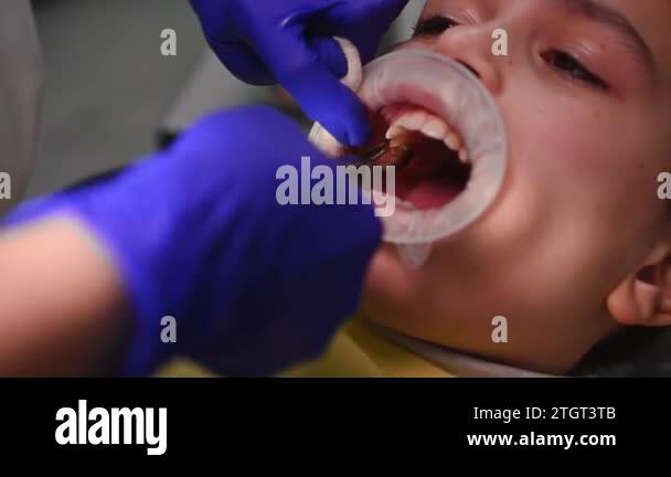Close-up of a real procedure for extracting a molar baby tooth that ...