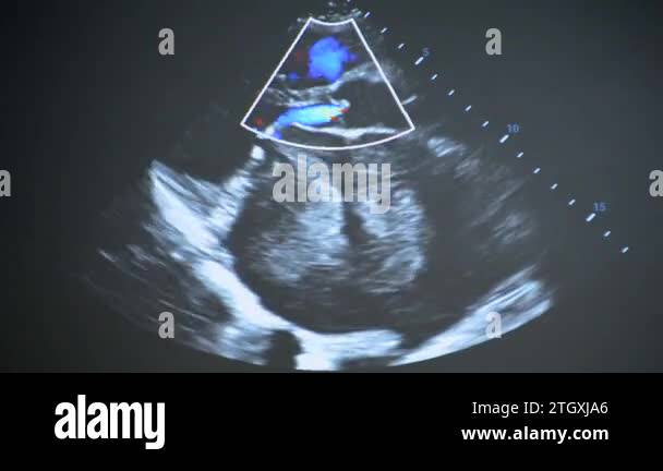 Utrasound image on the monitor close-up. Ultrasound Scan display ...