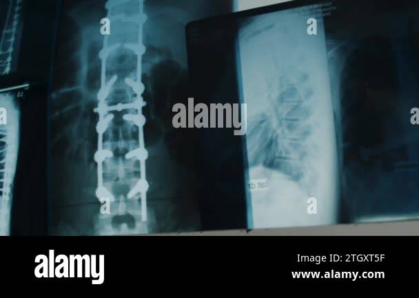 X-ray of whole spine AP and Lateral position in dark background. . High ...