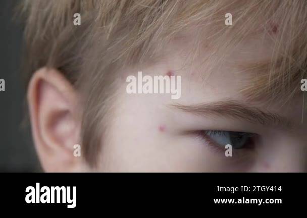 Close-up Kid Face Covered with Rash of Itchy Inflamed Blisters ...
