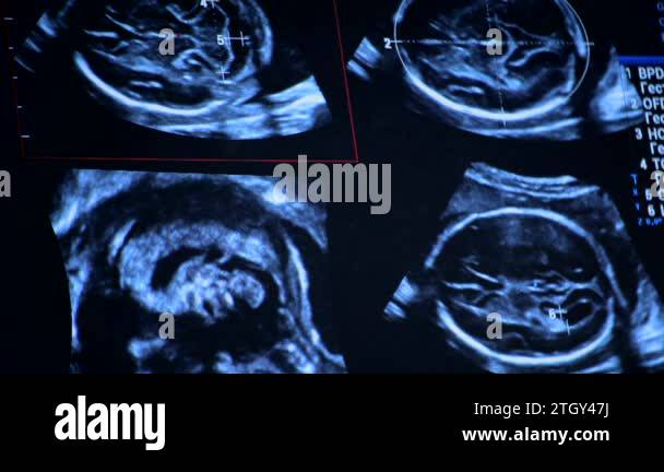 Utrasound image on the monitor close-up. Ultrasound Scan display ...