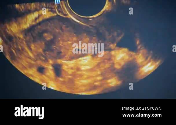 Utrasound image on the monitor close-up. Ultrasound Scan display ...