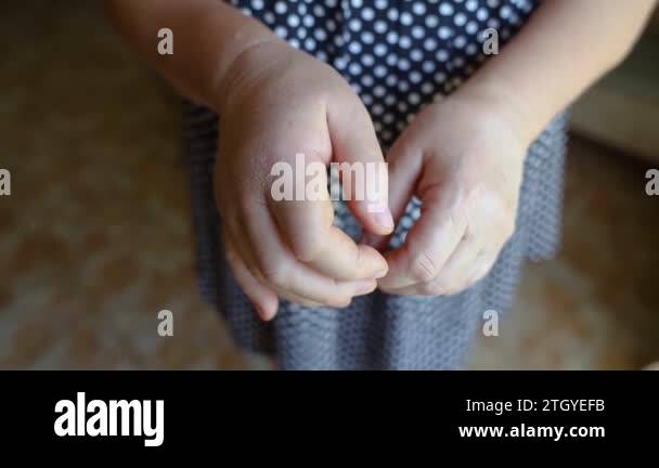 Close-up hand inflammation. Left hand was very swollen in region of the ...