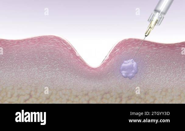 Skin tightening with dermal fillers or hyaluronic acid Injection. The ...