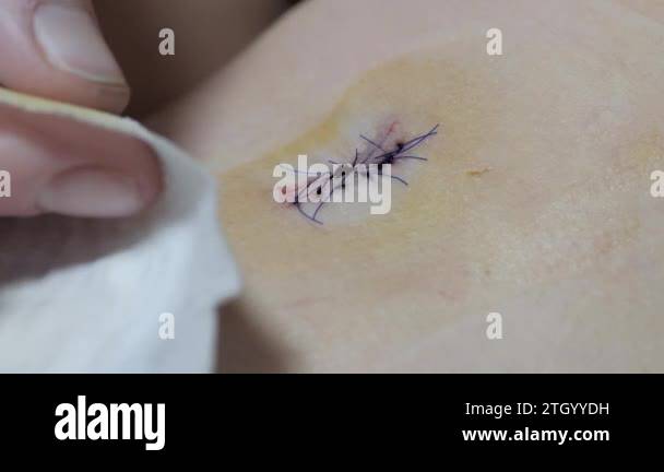 Skin cancer stitches after Stock Videos & Footage - HD and 4K Video ...