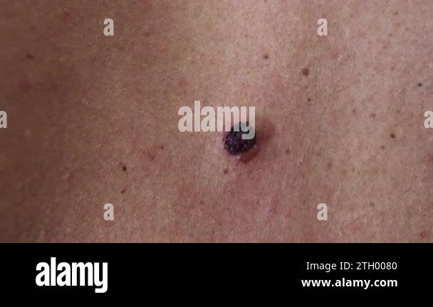 Mole treatment after cryotherapy. Dying seborrheic keratosis. Macro ...