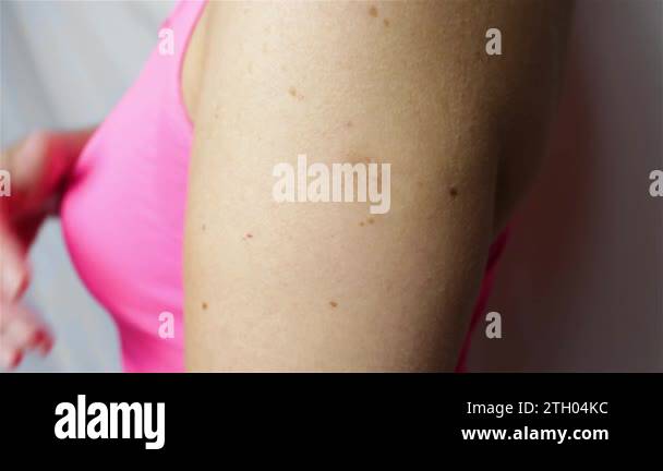 A scar from a smallpox vaccination is visible on an mature woman upper ...