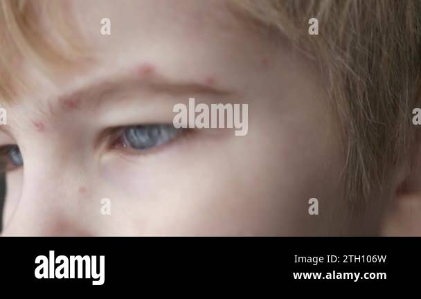 Close-up Kid Face Covered with Rash of Itchy Inflamed Blisters ...