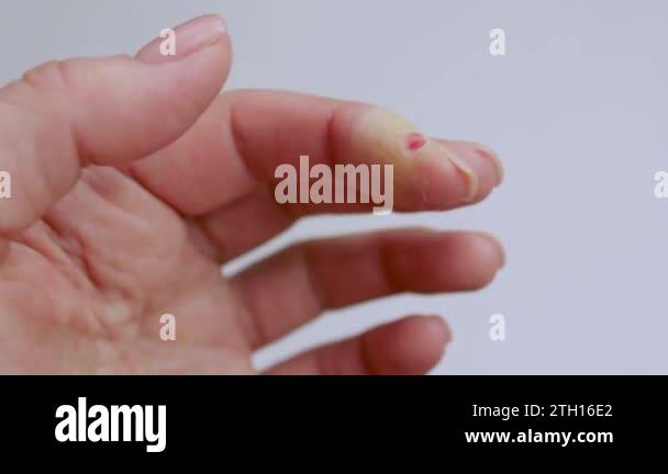 Wound on the finger close-up. First aid for injuries. Isolated ...