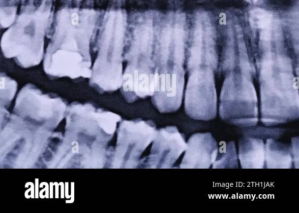 X-ray image of the jaw of all human teeth close-up. Magnetic resonance ...