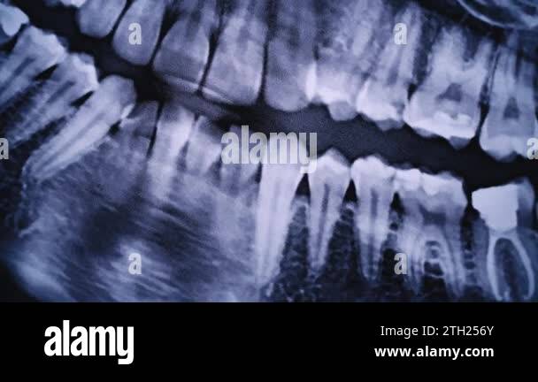 X-ray image of the jaw of all human teeth close-up. Magnetic resonance ...