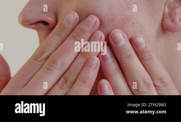 Close up view of woman acne skin caused by hormone. Red rash on young ...