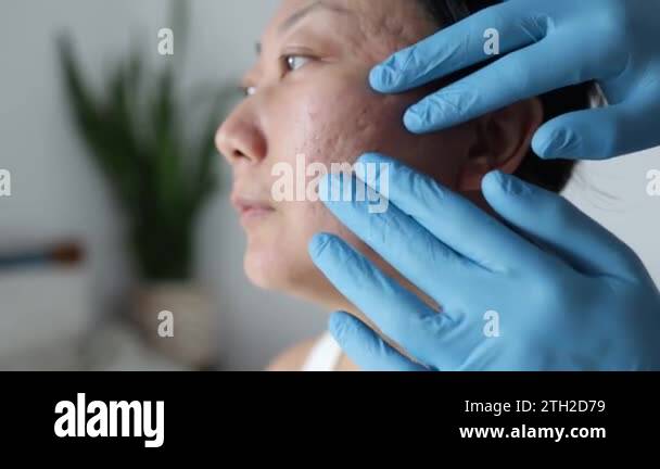 Dermatologist acne scar Stock Videos & Footage - HD and 4K Video Clips ...