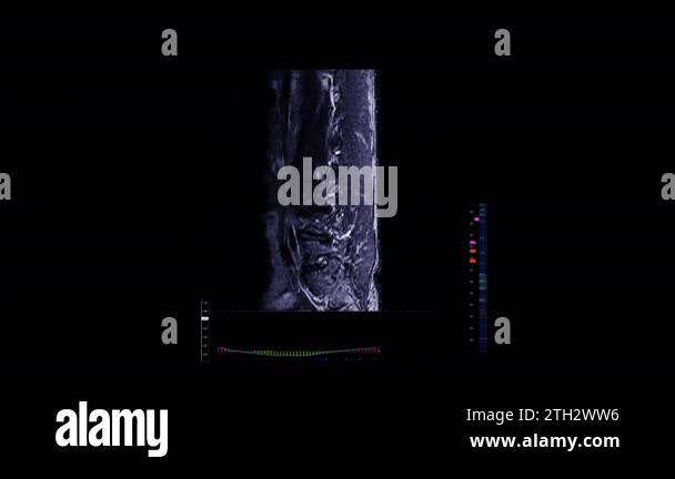 MRI Lumbar Back Bones Data ScreenA computer screen with a futuristic ...