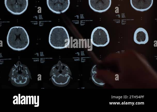 Magnetic resonance imaging of the brain from different sides, traumatic ...