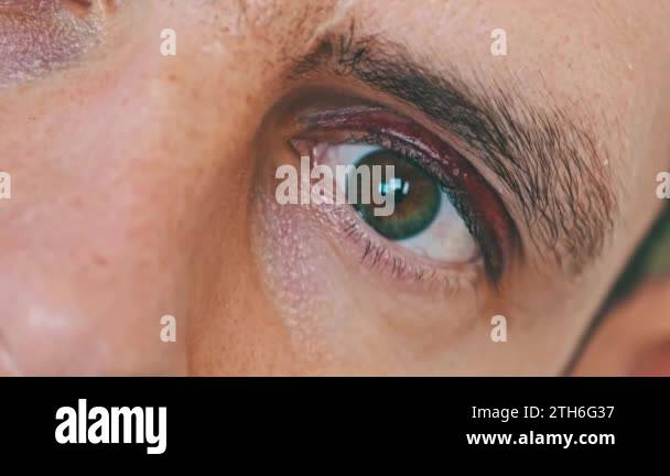 A real black eye on the young male face. A bruise on a mans eyelid ...