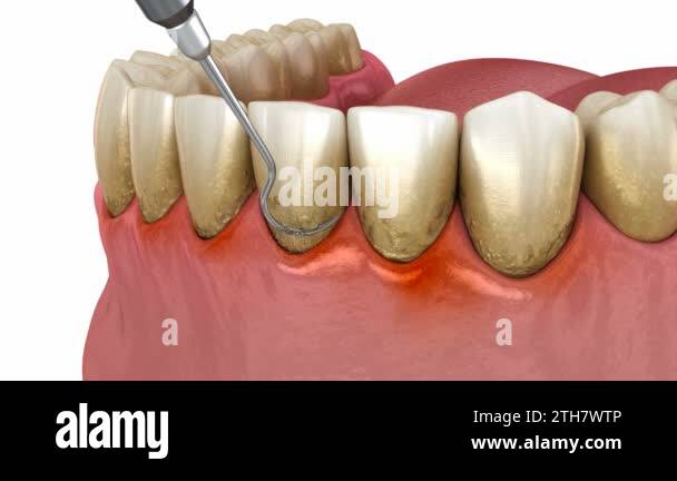 Therapy periodontal Stock Videos & Footage - HD and 4K Video Clips - Alamy