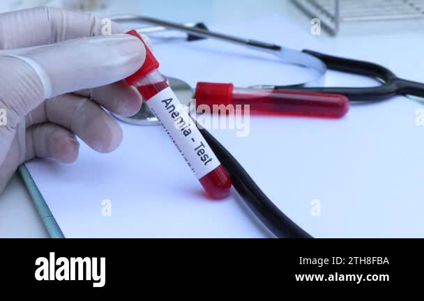 anemia test to look for abnormalities from blood, blood sample to ...