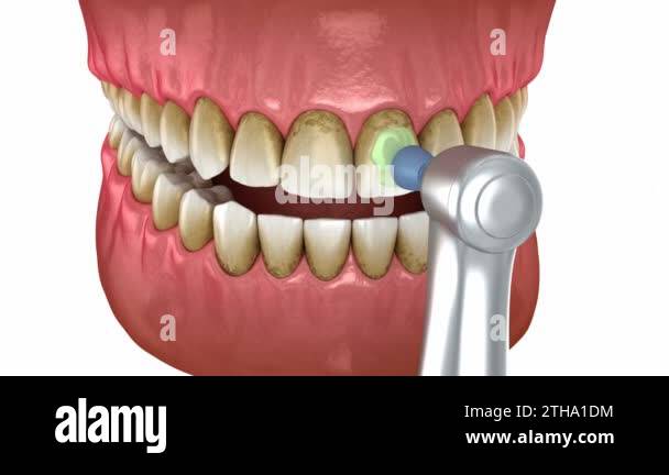 Teeth polishing procedure Stock Videos & Footage - HD and 4K Video ...